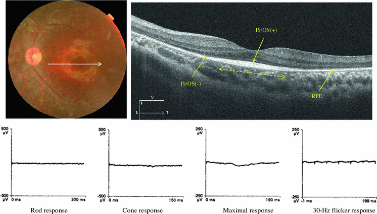 Inverse pattern of photoreceptor abnormalities in retinitis pigmentosa ...