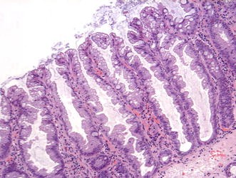 Sessile serrated polyps of the colorectum are rare in patients with ...