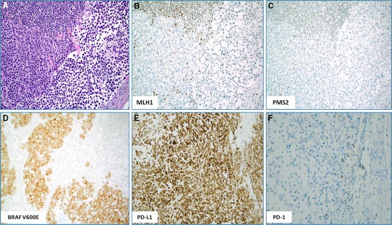 High microsatellite instability (MSI-H) colorectal carcinoma: a brief ...