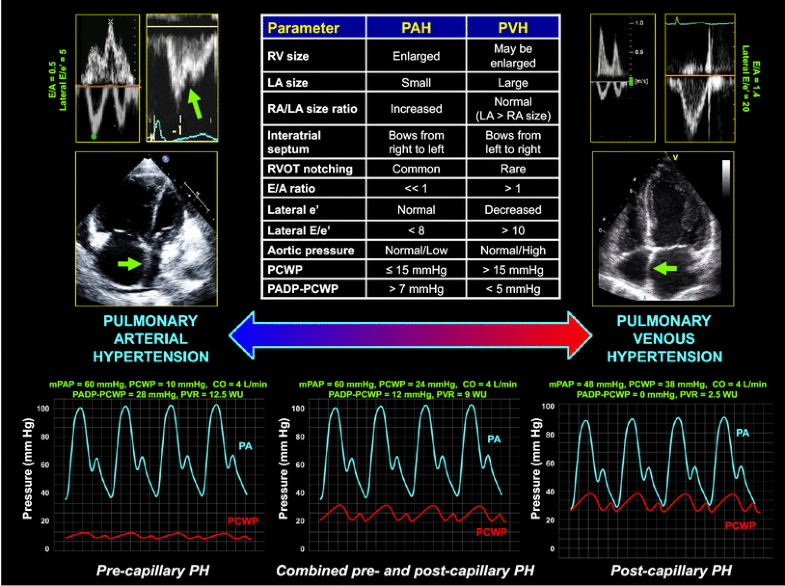 Combined post- and pre-capillary pulmonary hypertension in heart ...