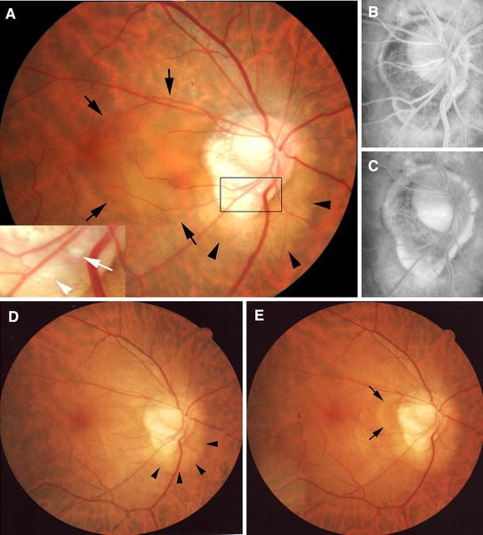 Macular retinal detachment associated with peripapillary detachment in ...