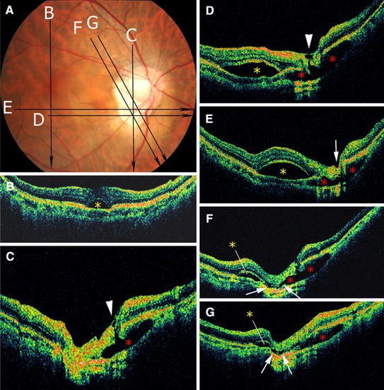 Macular retinal detachment associated with peripapillary detachment in pathologic myopia ...