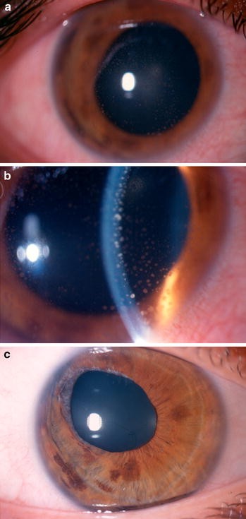Clinical features and prognosis of herpetic anterior uveitis: a ...
