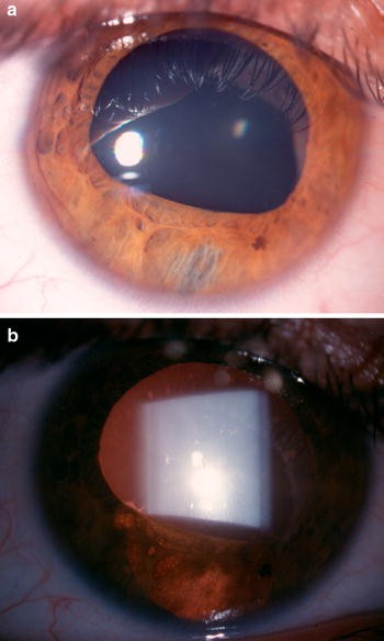 Clinical features and prognosis of herpetic anterior uveitis: a ...