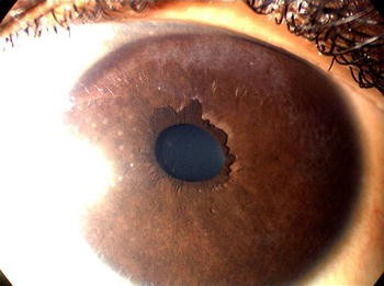 Congenital ectropion uveae presenting as acute glaucoma in a 3-year-old ...