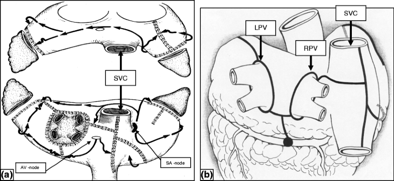 The Cox-Maze procedure: History, results, and predictors for failure ...