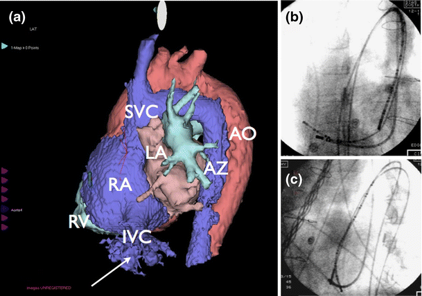 Real-time integration of intracardiac echocardiography and 3D ...