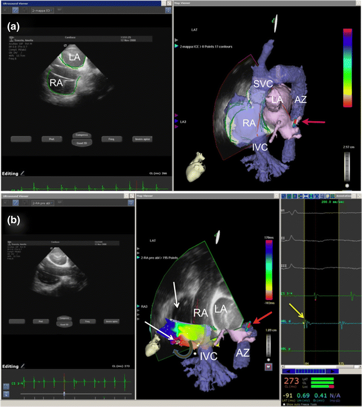 Real-time integration of intracardiac echocardiography and 3D electroanatomical mapping to guide ...