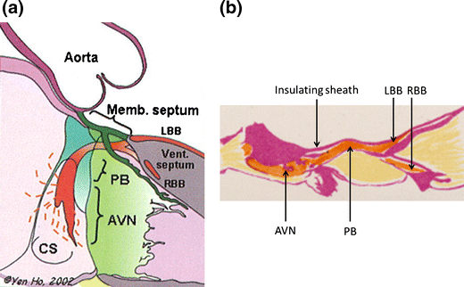 The infrahisian conduction system and endocavitary cardiac structures ...