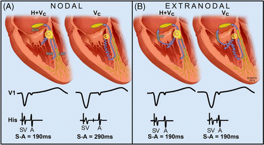 Parahisian pacing: technique, utility, and pitfalls | SpringerLink