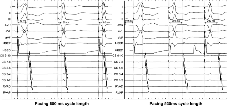 Parahisian pacing: technique, utility, and pitfalls | SpringerLink