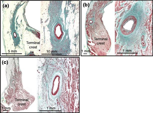 Anatomy and pathology of the sinus node | SpringerLink