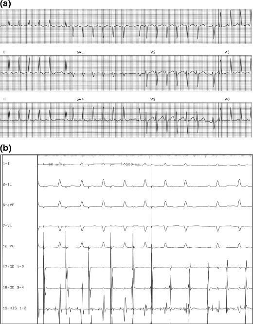 Clinical presentation of inappropriate sinus tachycardia and ...