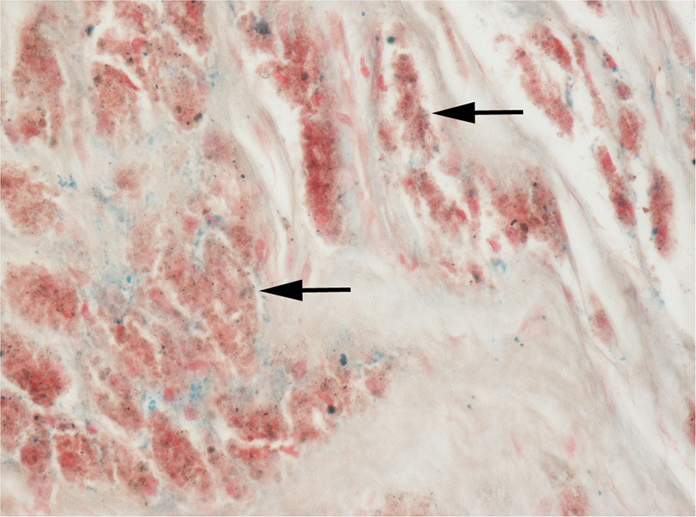 Solochrome cyanine: A histological stain for cobalt-chromium wear ...