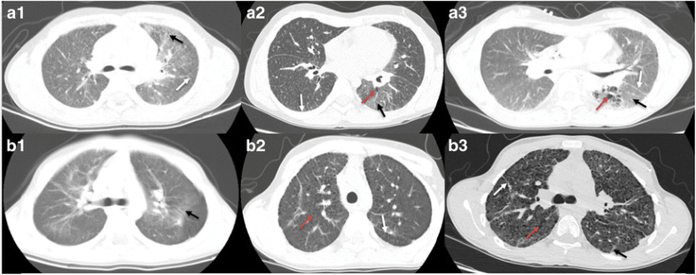 Copa Syndrome: a Novel Autosomal Dominant Immune Dysregulatory Disease ...