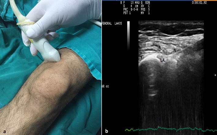 Which imaging method should be used for genicular nerve radio frequency ...