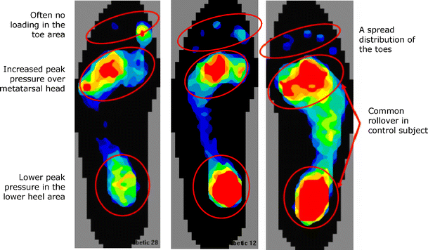 Automated Identification of Diabetic Type 2 Subjects with and without ...
