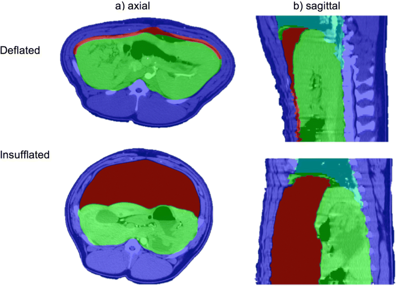 Patient-Specific Simulation of Pneumoperitoneum for Laparoscopic ...
