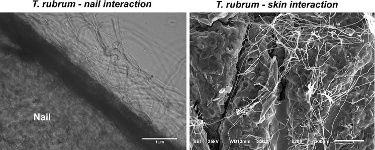 Pathogenesis of Dermatophytosis: Sensing the Host Tissue | SpringerLink