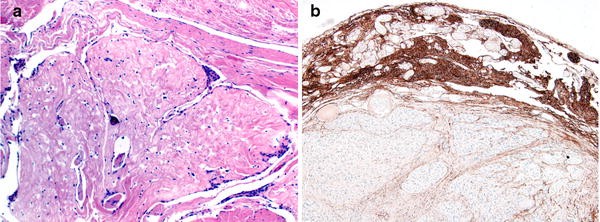 Pathological classification and molecular genetics of meningiomas ...