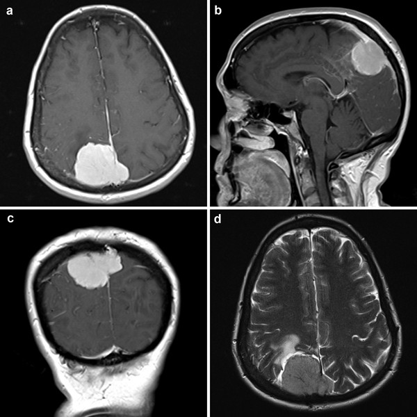 Resection of falx and parasagittal meningioma: complication avoidance ...