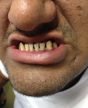 Acromegaly: clinical features at diagnosis | SpringerLink