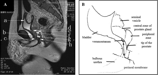Normal anatomy of urethral sphincter complex in young Chinese males on ...
