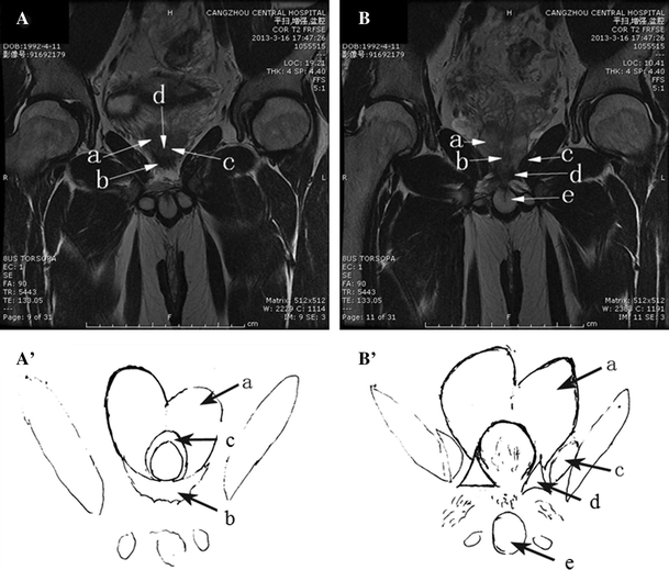 Normal anatomy of urethral sphincter complex in young Chinese males on ...