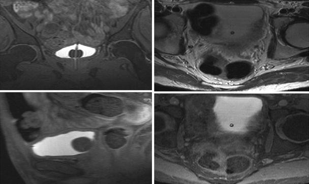 Delayed contrast-enhanced MRI to localize Botox after cystoscopic ...