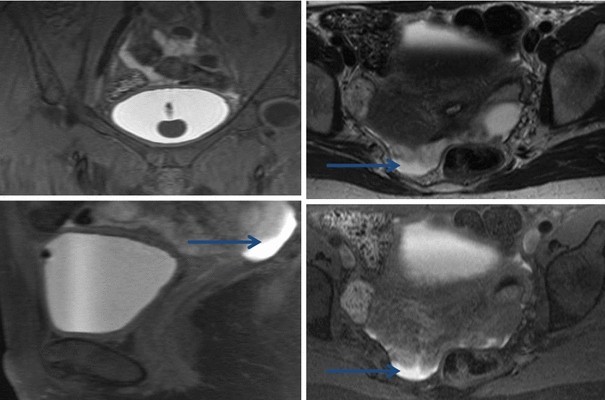 Delayed contrast-enhanced MRI to localize Botox after cystoscopic ...