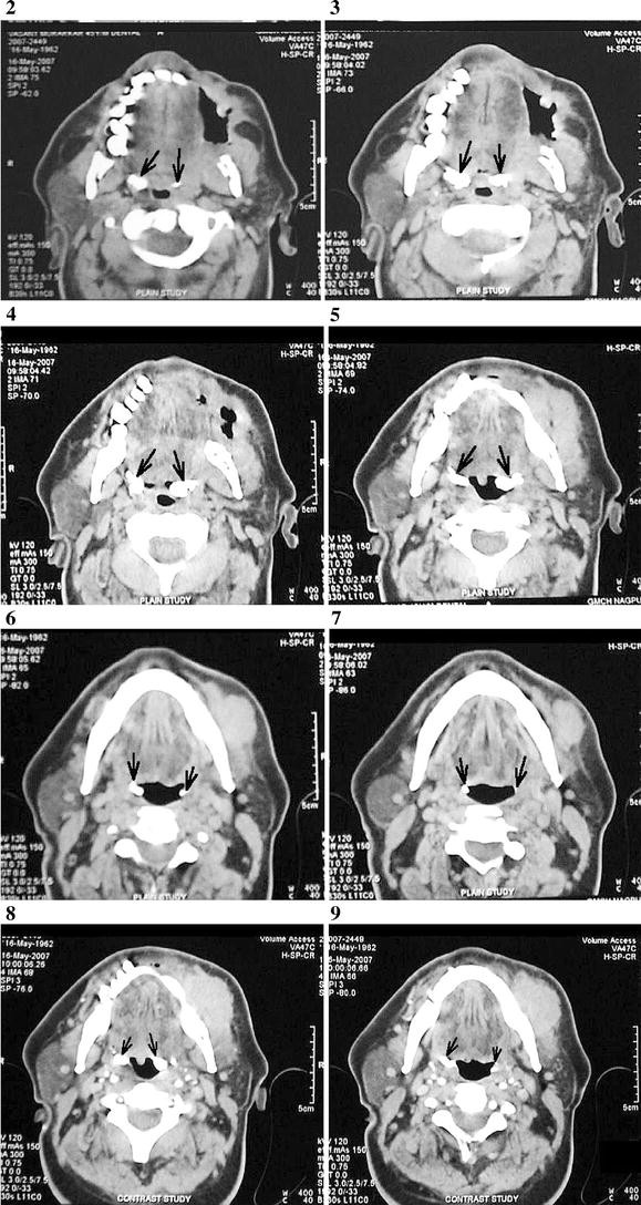 Bilateral multiple tonsilloliths | SpringerLink