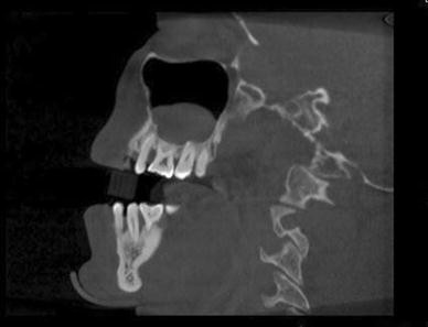 Relationship between maxillary sinus pathologies and maxillary ...