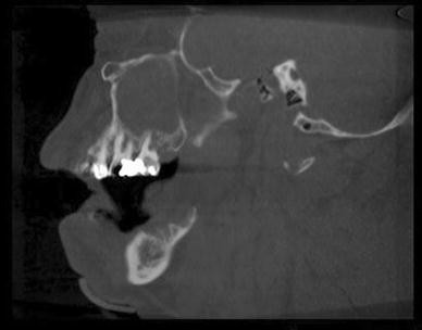 Relationship between maxillary sinus pathologies and maxillary ...