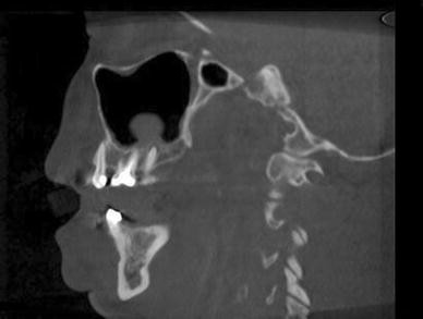 Relationship between maxillary sinus pathologies and maxillary ...