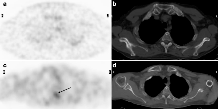 68Ga-DOTA-NOC PET/CT Imaging of Neuroendocrine Tumors: Comparison with ...