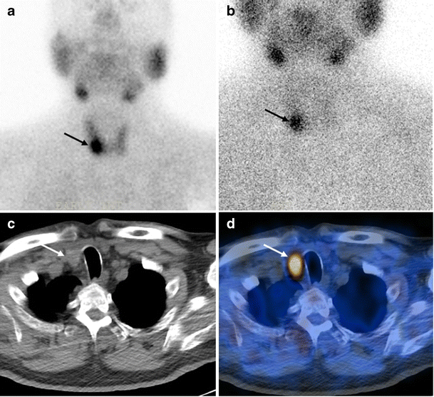 Preoperative [99mTc]MIBI SPECT/CT Interpretation Criteria for ...