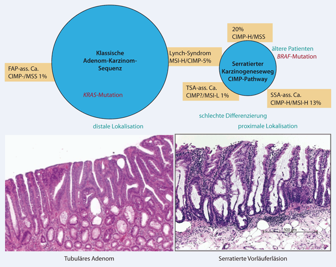 Differenzierte Bewertung der Adenom-Karzinom-Sequenz beim kolorektalen ...