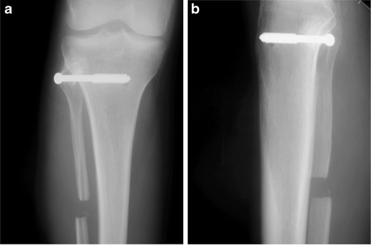 Successful Fusion of the Proximal Tibiofibular Joint with Osteogenic ...