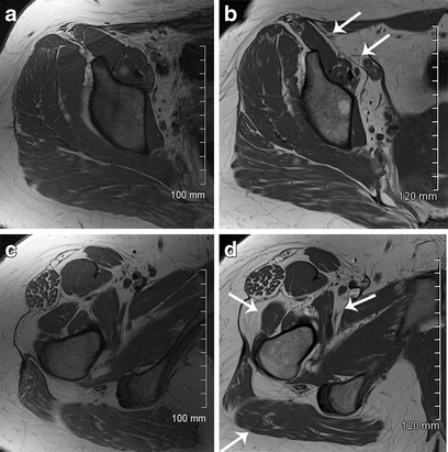 MR Appearance and Clinical Significance of Changes in the Hip Muscles ...