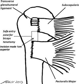 Ultrasound-Guided Percutaneous Long Head of the Biceps Tenotomy: a ...