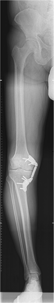 Failure of a Knee Joint Load Absorber: Pain, Metallosis and Soft Tissue ...
