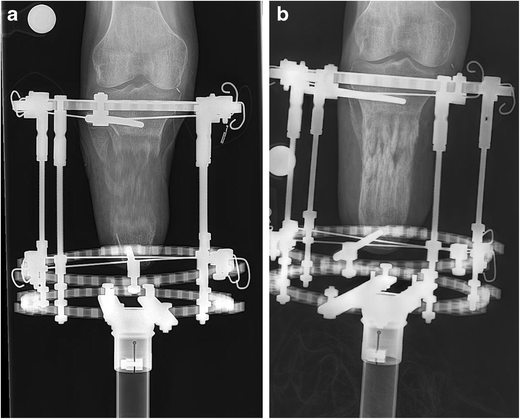 Lengthening of Tibia after Trans-Tibial Amputation: Use of a Weight ...