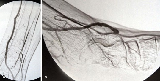 Arterielle Revaskularisation beim diabetischen Fußsyndrom | SpringerLink