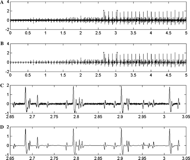 MUAP extraction and classification based on wavelet transform and ICA ...