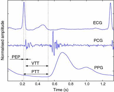 Pulse wave transit time for monitoring respiration rate | SpringerLink