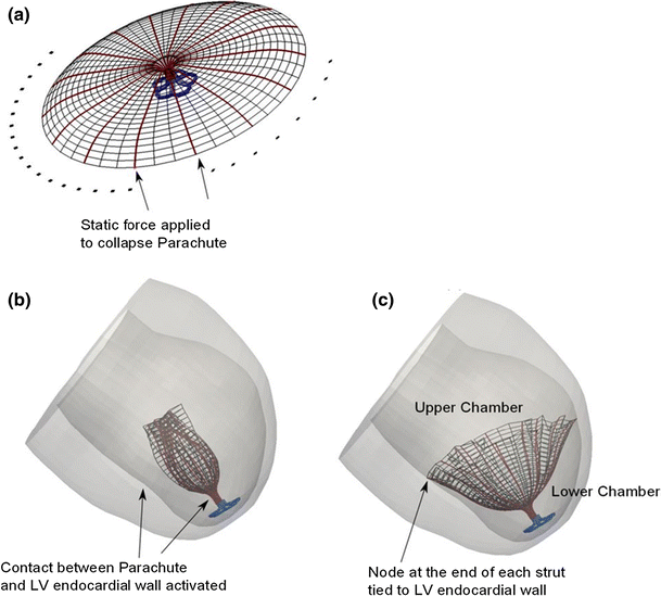 Patient-specific finite element modeling of the Cardiokinetix Parachute ...