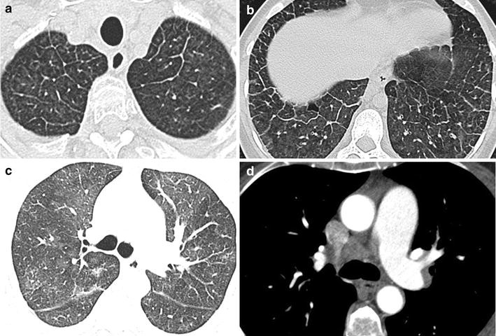 Pulmonary veno-occlusive disease: the role of CT | SpringerLink