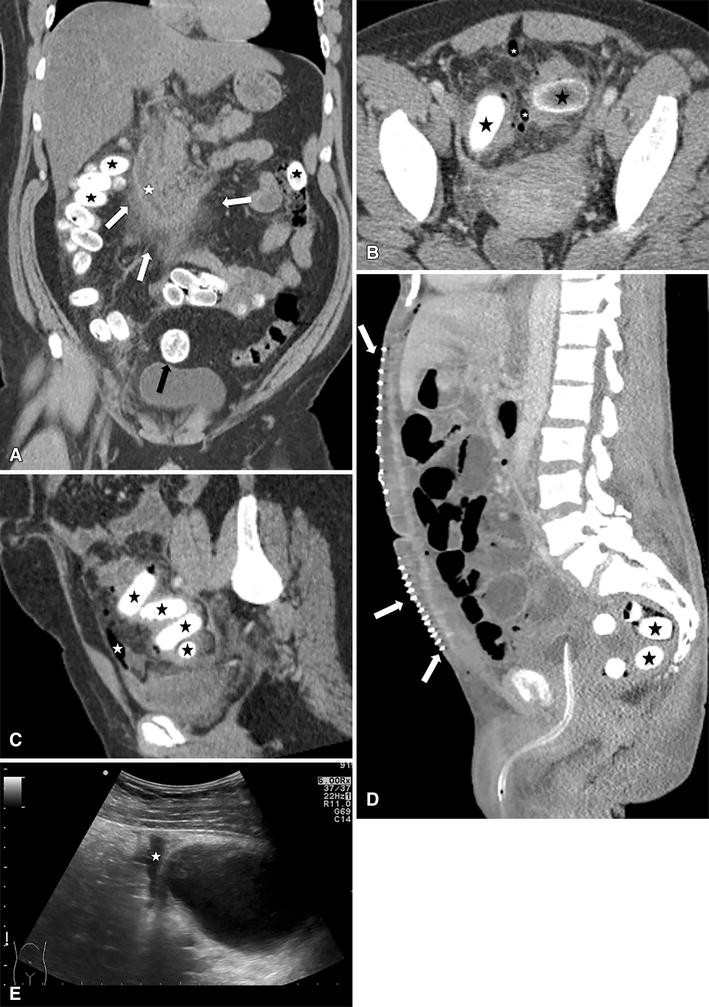 Body packing: a review of general background, clinical and imaging ...
