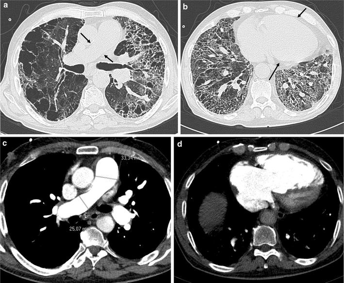 Combined pulmonary fibrosis and emphysema (CPFE): what radiologist ...