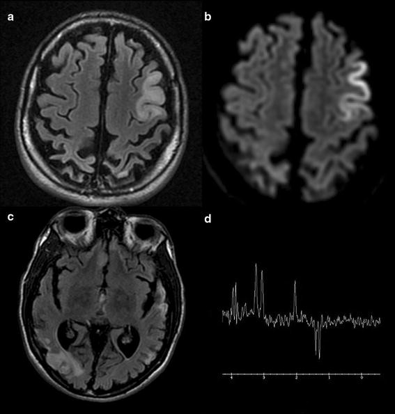 Neuroradiology of human prion diseases, diagnosis and differential ...